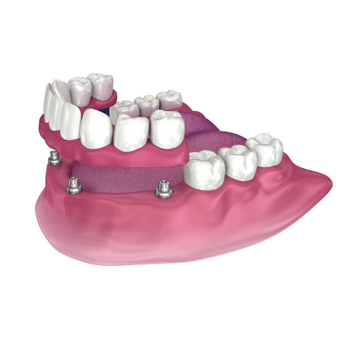 Dental Implants | Olathe, Gardner & Lenexa, KS | UpCare Dental